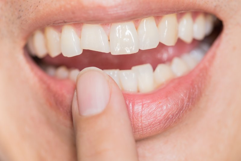 What To Do If You Chip A Tooth Kent | Complete Dental Care